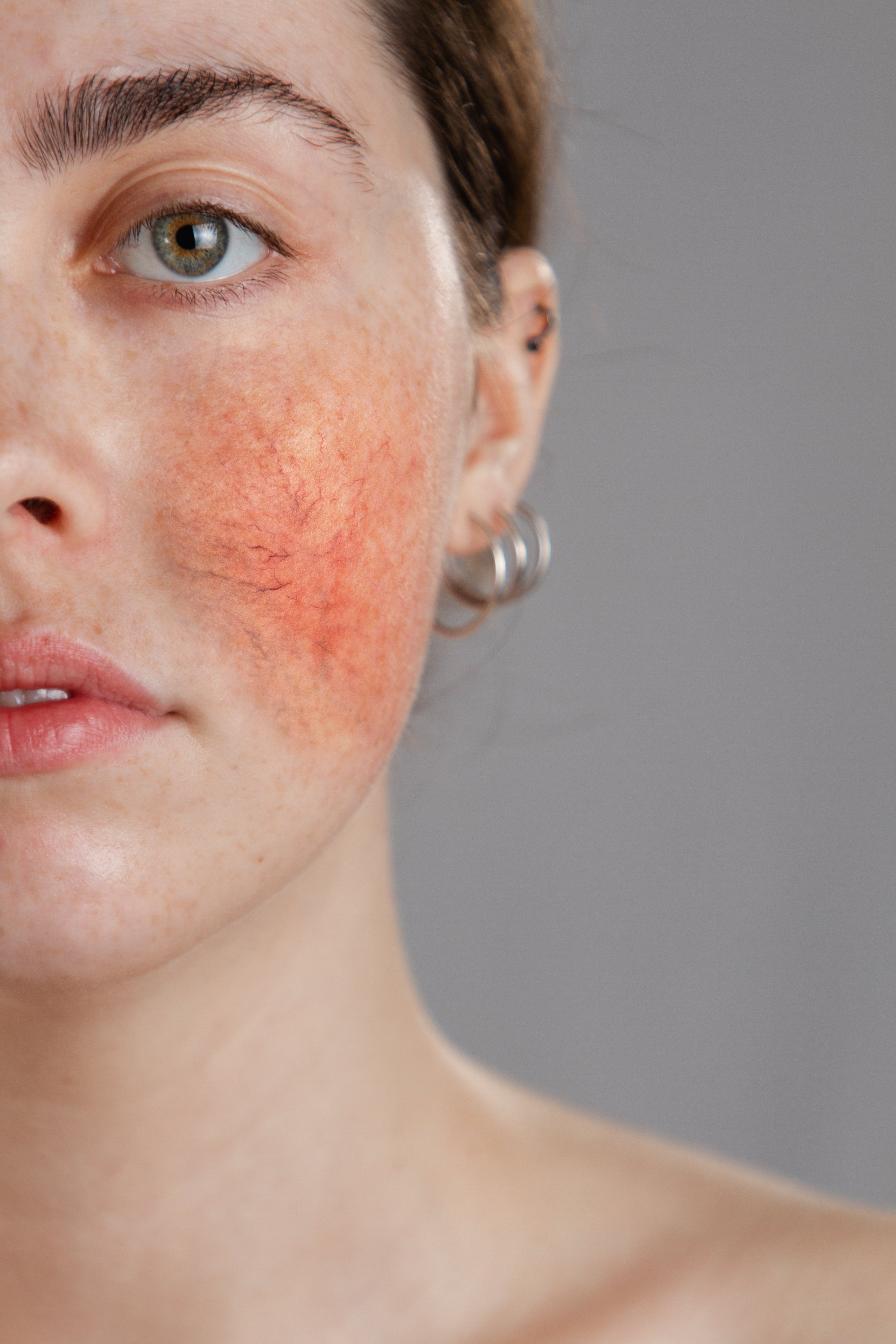 Managing Rosacea: Clinical Skincare Solutions for Soothing Symptoms ...