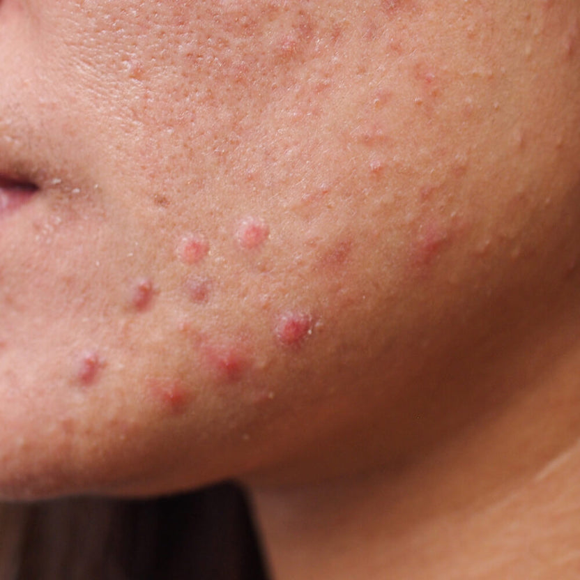 Acne | Medical Grade Skincare | Replenix